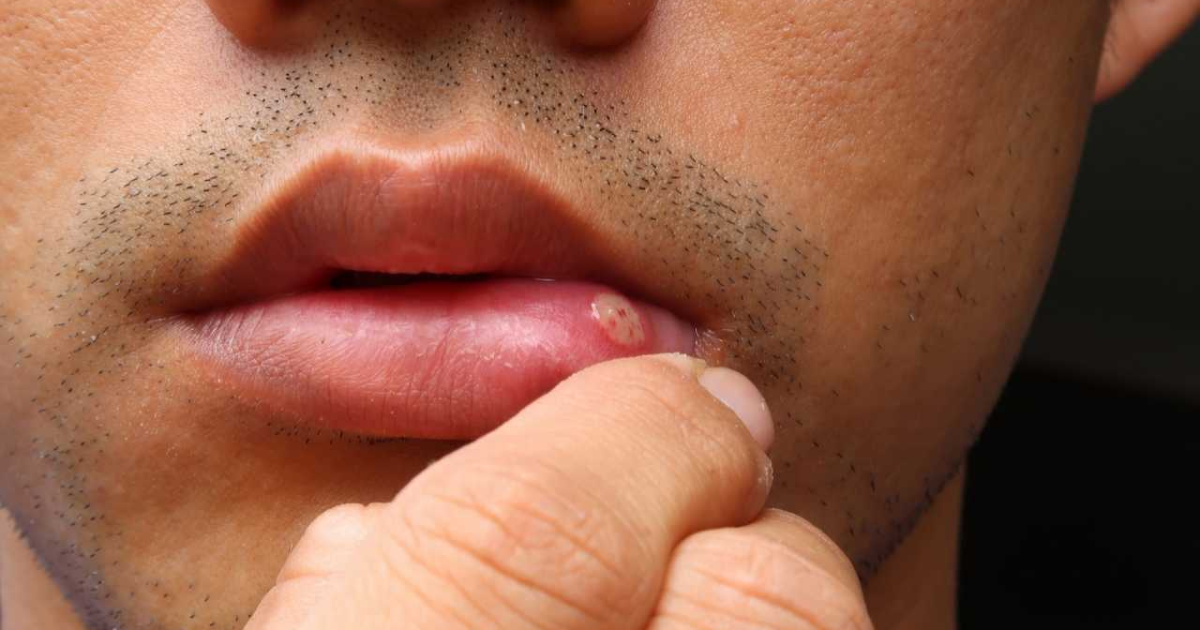 Canker Sore | Patient Education Videos | Patient Video