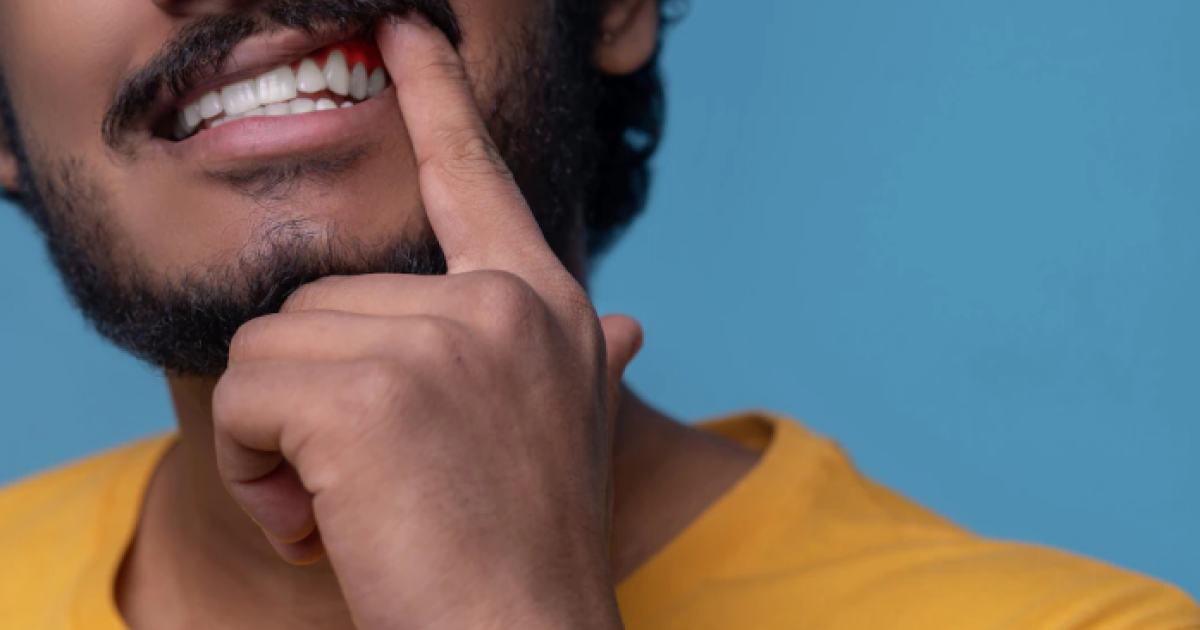 Gum Flap Surgery | Patient Education Videos | Patient Video